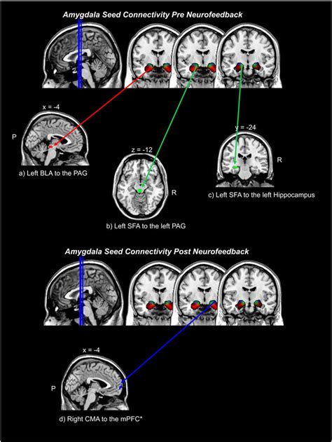 Clusters Representing Greater Connectivity From Amygdala Complex Seeds Download Scientific