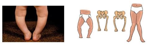 Osteomalacia Rickets Osteomalacia Causes Symptoms Diagnosis