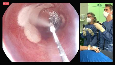 David Hedrick Mba On Linkedin Endoscopy Barretts Gerd Giendoscopy