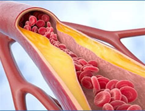 Comparison Of Atopic Dermatitis Transcriptome Profiling By Microarray And Rna Seq Rna Seq Blog