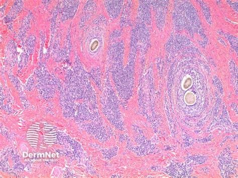 Acne Keloidalis Nuchae Pathology