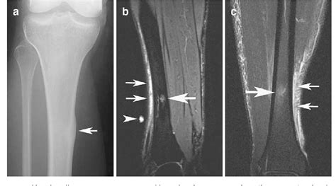 Stress Fracture Shin Nhs Tibial Stress Syndrome Shin Splints Ihuf