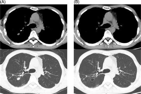 Chest Computed Tomography Ct Shows A Lung Nodule And A Calcified