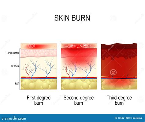 Three Main Layers Of Skin Burns