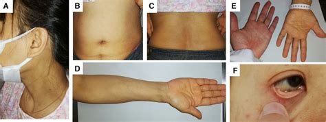 Carotenemia Induced By Iron Deficiency Bmj Case Reports