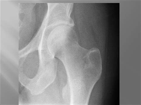 Рентгенологическое исследование тазобедренных суставов презентация онлайн