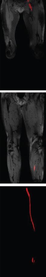Representative Segmentation Results Of A Patient Obtained From An