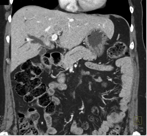 Cholangiocarcinoma Liver Case Studies Ctisus Ct Scanning