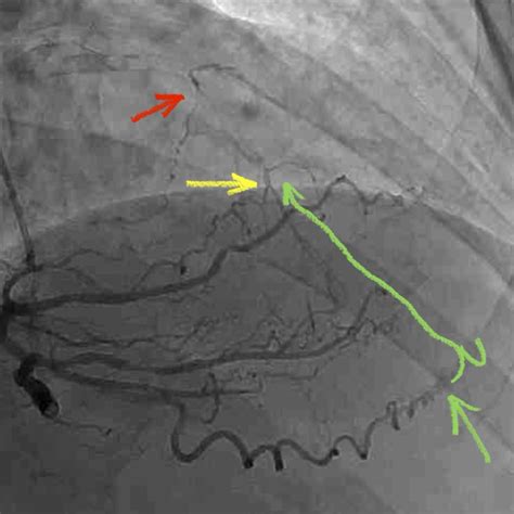A Tough Chronic Total Occlusion Cto Globemedic