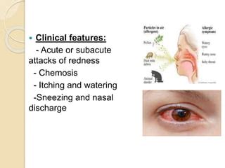 Allergic Conjuntivitis Ppt
