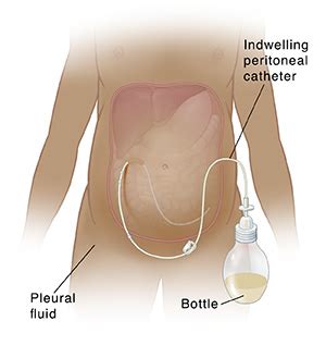 Indwelling Peritoneal Catheter For Abdominal Drainage Healthhub