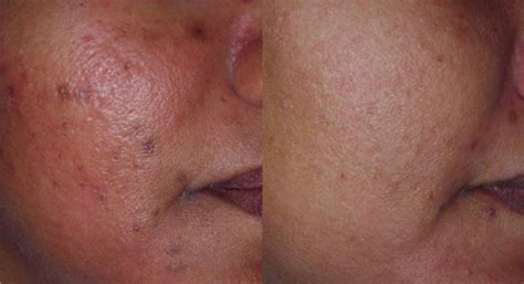 Acne Excoriée Treatment Best Solutions For Picking Acne Brisbane