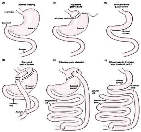 Roux En Y Gastric Bypass Upper Gi