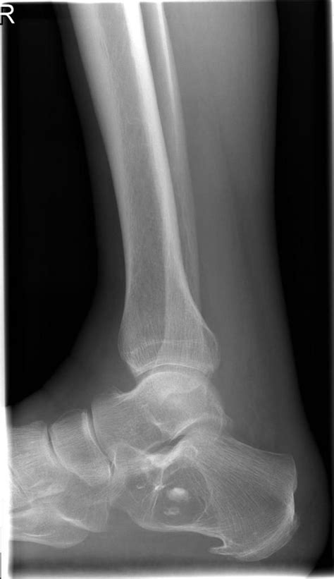 Intraosseous Lipoma Radiology Case Radiopaedia Org Radiology Medical Anatomy Human Joints