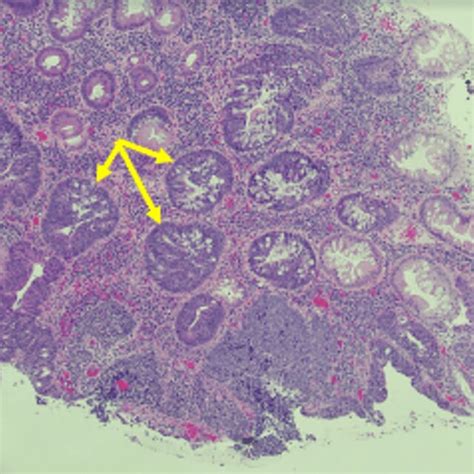 Rectal Mass Specimen Hande Hematoxylin And Eosin Of The Biopsy Shows Download Scientific Diagram