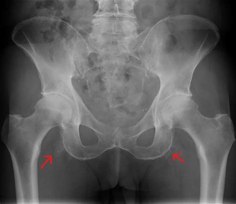 Bilateral Hamstring Origin Calcification Rare Presentation Of Gitelman Syndrome Bmj Case Reports