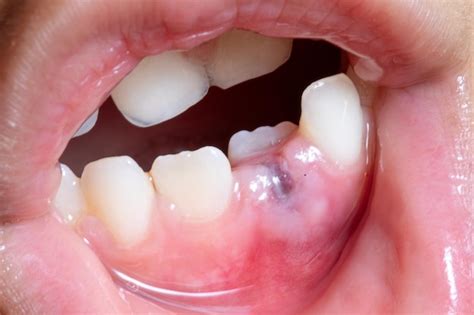 Primer Plano De Las Encías Inflamadas Con Absceso Dental Y Caries Dental Foto Premium