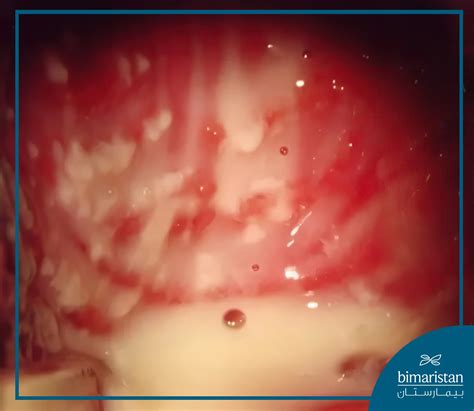 Vaginitis Treatment For Married Women Bimaristan