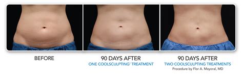Coolsculpting Freeze The Fat Beverly Hills Los Angeles West