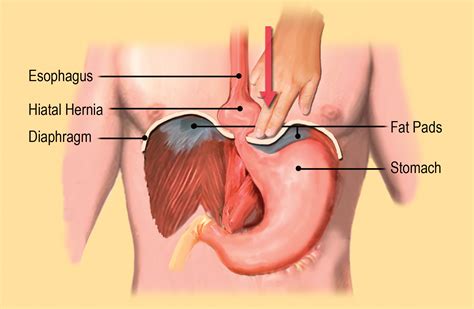 Hiatal Hernia Acid Reflux And Gerd
