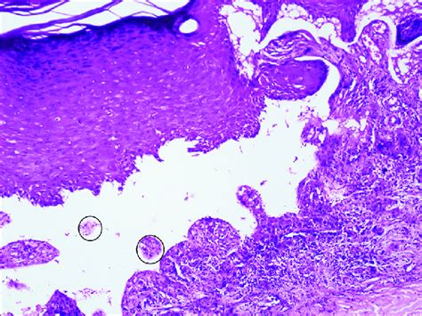 Epidermis Showing Hypergranulosis Interface Dermatitis And Necrotic