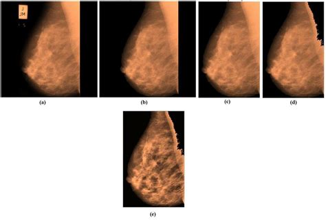 Preprocessing Phases A Original Image B Getting The Breast And