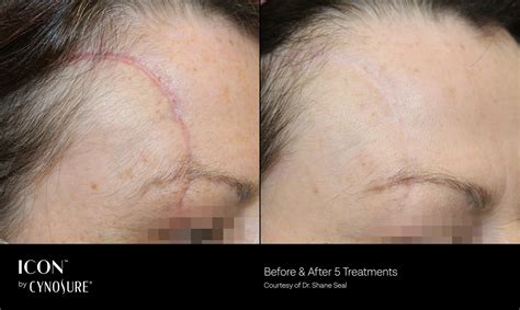 The Cynosure Icon 1540 Laser VINA Laser Med Spa