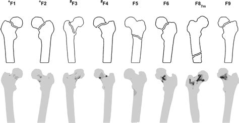 Can Patient Specific Finite Element Models Better Predict Fractures In Metastatic Bone Disease