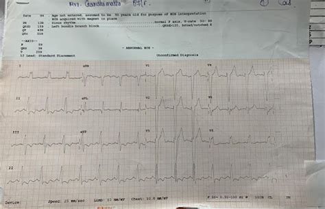 Reversible Cause Of Severe Lv Dysfunction In Left Bundle Branch Block Kauvery Hospital