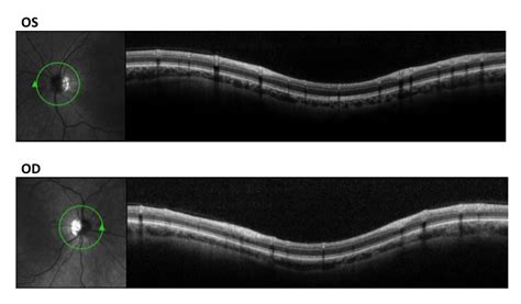 Moran Core Two Cases Of Wolfram Syndrome