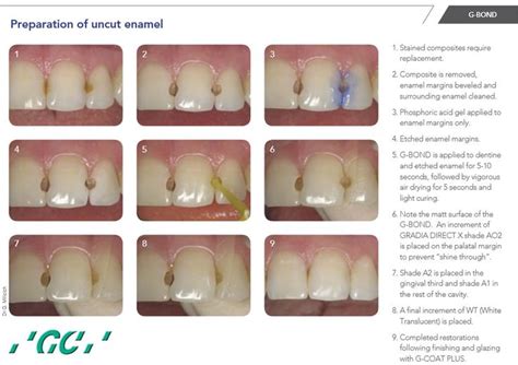 Preparation Of Uncut Enamel For Additional Mechanical Retention Uncut Enamel Can Be Etched