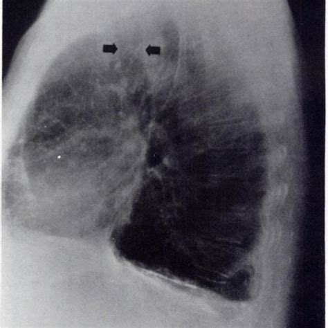 Ct Scan Showing A Hyperlucent And Hyperexpanded Left Upper Lobe With An Download Scientific
