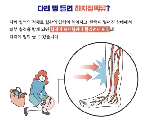 다리 멍 잘 든다면 하지정맥류 의심해보세요 김병준 원장의 건강한 다리 이야기