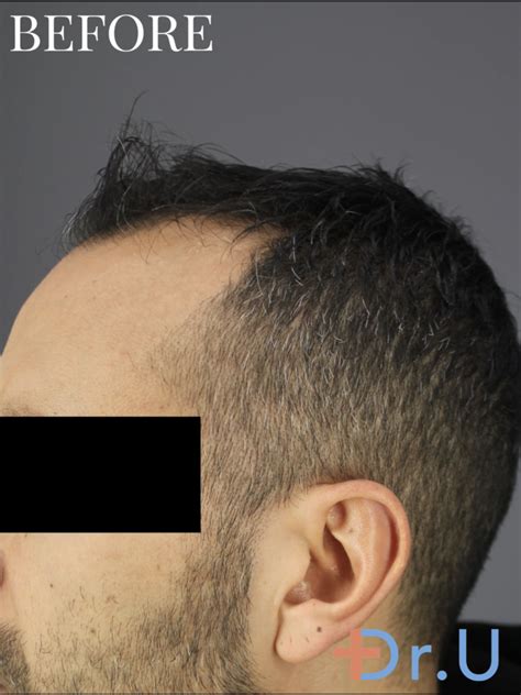 The Young Man Underwent A Mid Scalp Hair Restoration Surgery