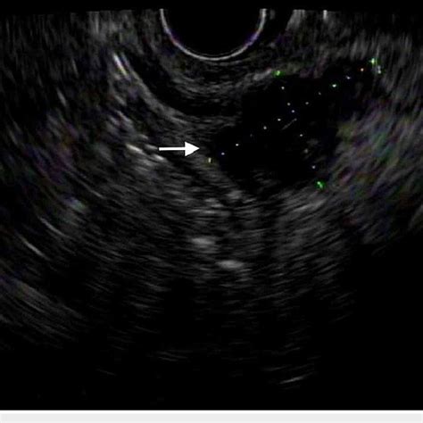 Endoscopic Ultrasound Showed A Hypoechoic Circumferential Mass Download Scientific Diagram