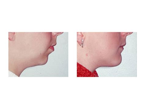 Sliding Genioplasty Dr Barry Eppley Indianapolis Explore Plastic Surgery