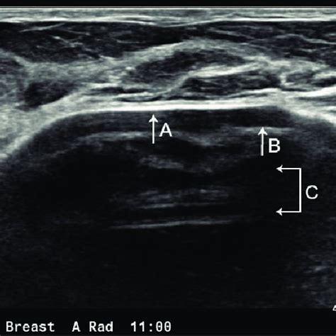 Stepladder Sign Transverse Ultrasound Demonstrates An Intracapsular