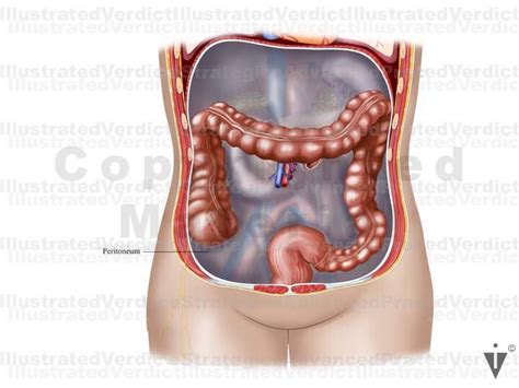 Stock Appendix Appendicitis Retrocecal — Illustrated Verdict