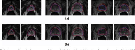 Figure 13 From Deformable Segmentation Of 3d Mr Prostate Images Via Distributed Discriminative
