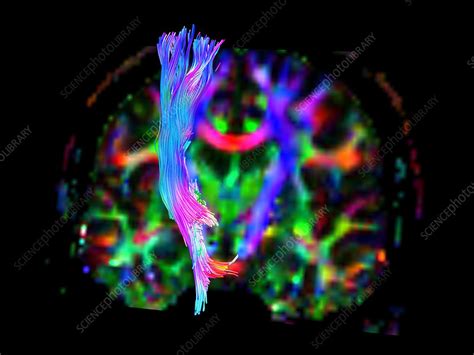 Brain Fibre Tracts Dti Scan Stock Image C030 6332 Science Photo Library