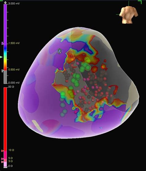 Course Of Left Phrenic Nerve During Epicardial Vt Ablation Epicardial Download Scientific