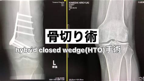 半月板損傷骨切り術 運動が出来るようになりました YouTube