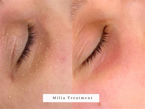 Milia Removal Before And After