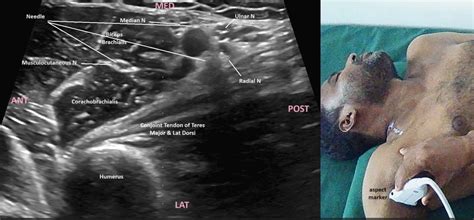 USG Guided Brachial Plexus Block A Precision Approach
