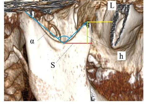 Figure 1 From Determination Of Coronoid Process Hyperplasia Of The Mandible Upon Ankylosing