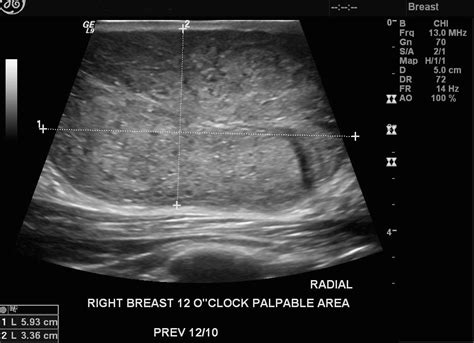 Ultrasound Characteristics Of Phyllodes Tumors Rodrigo Arrangoiz Ms