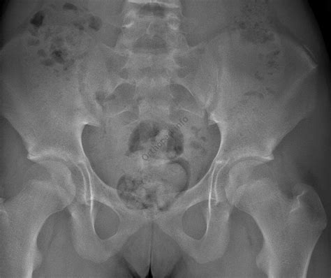 Test De Risser Evaluation De La Croissance Résiduelle Du Rachis