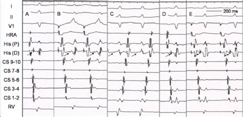 Intracardiac Electrograms During Sinus Rhythm At Baseline A Atrial