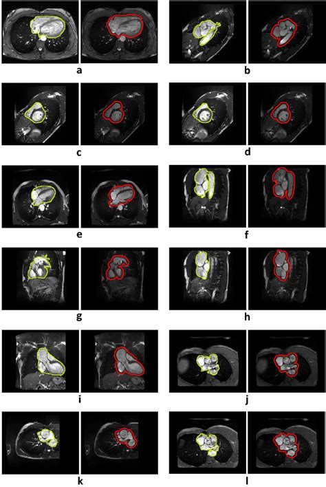 Figure 6 From Automatic And Fast Whole Heart Segmentation For 3d Reconstruction Semantic Scholar