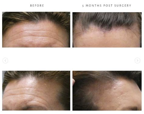 Pretrichial Brow Lift Vei Aesthetics